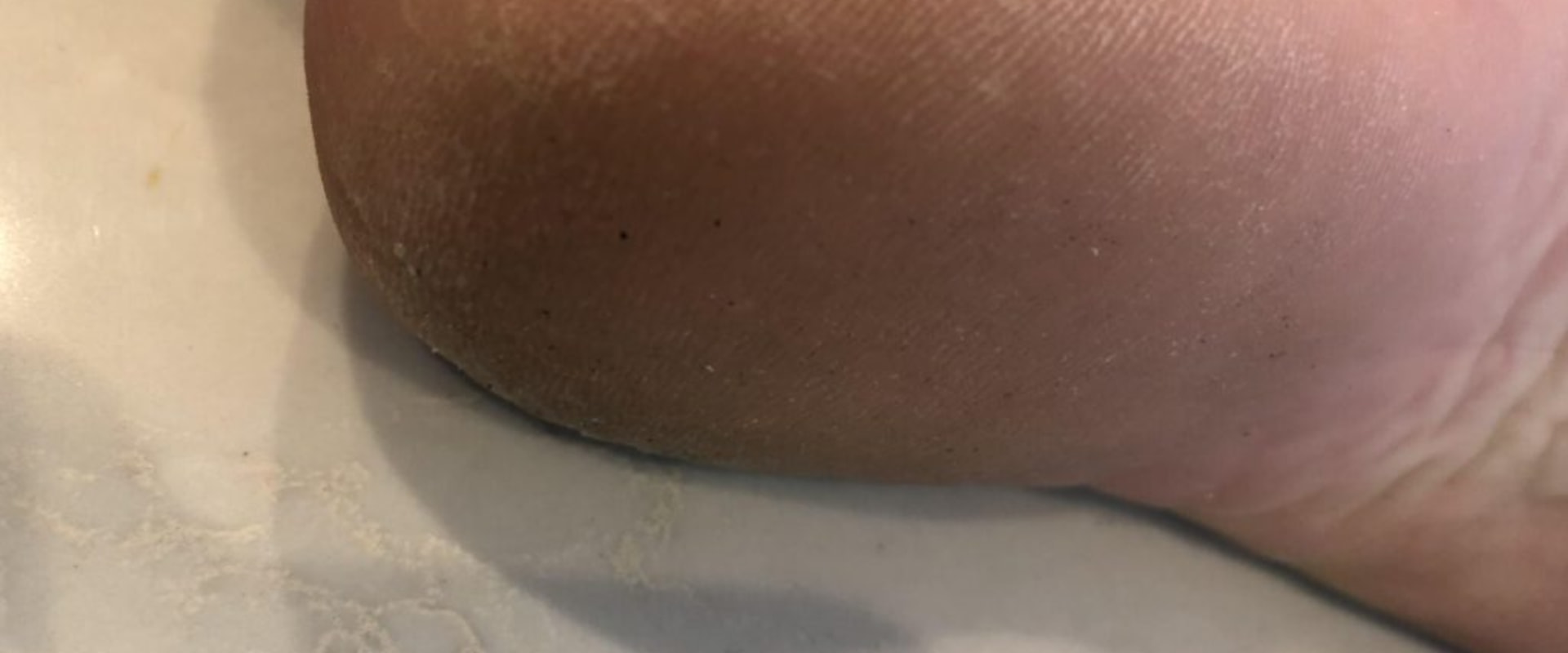 Understanding VA Disability Ratings for Flat Feet