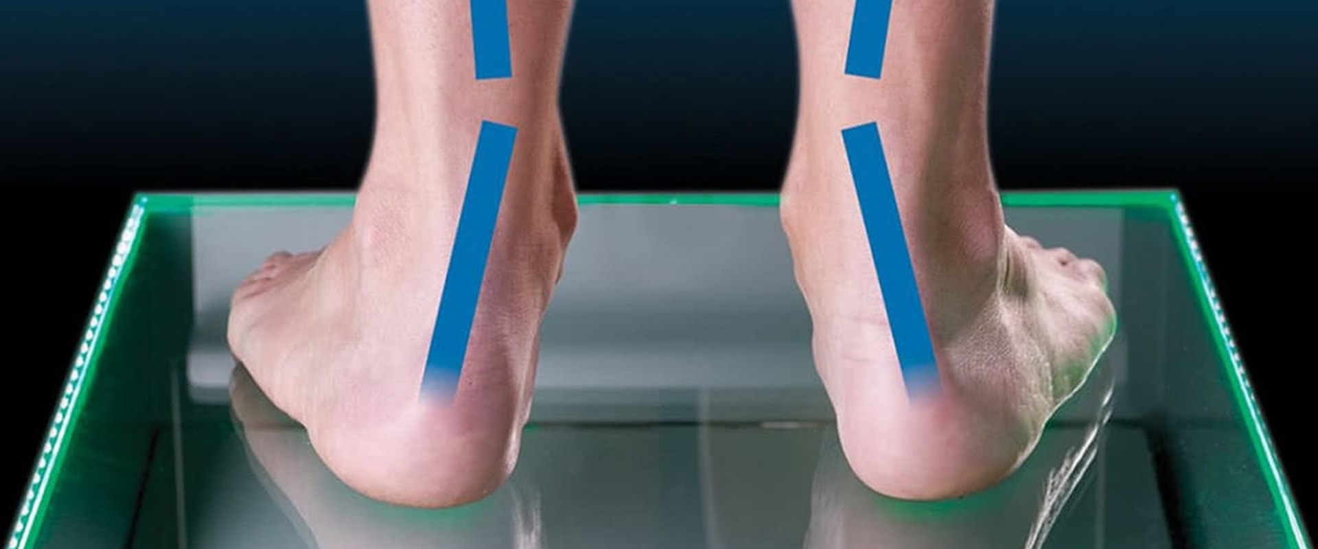 Understanding the Causes of Flat Feet