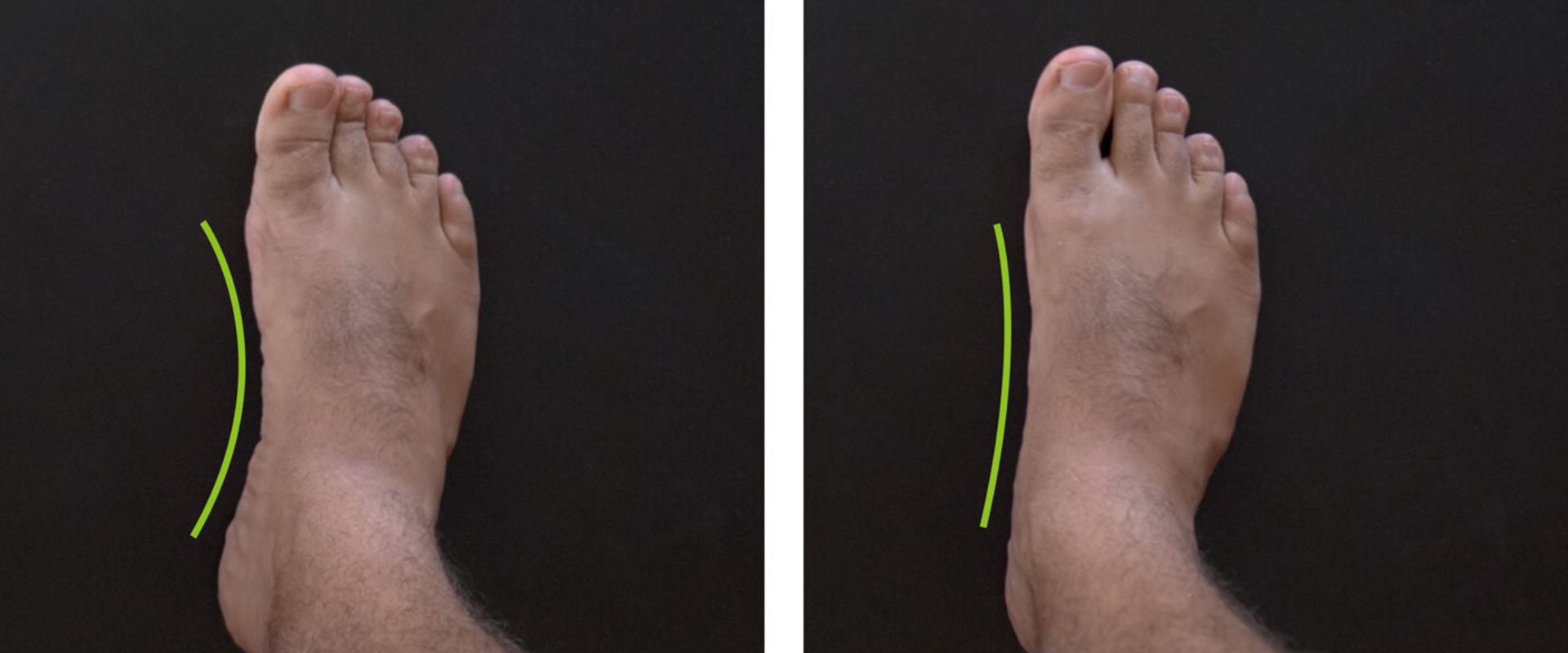 The Truth About Flat Feet: Can They Be Reversed?