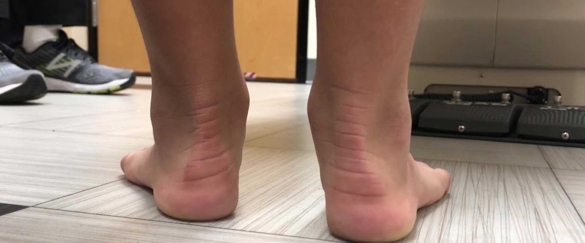 Understanding Flat Feet as a Disability