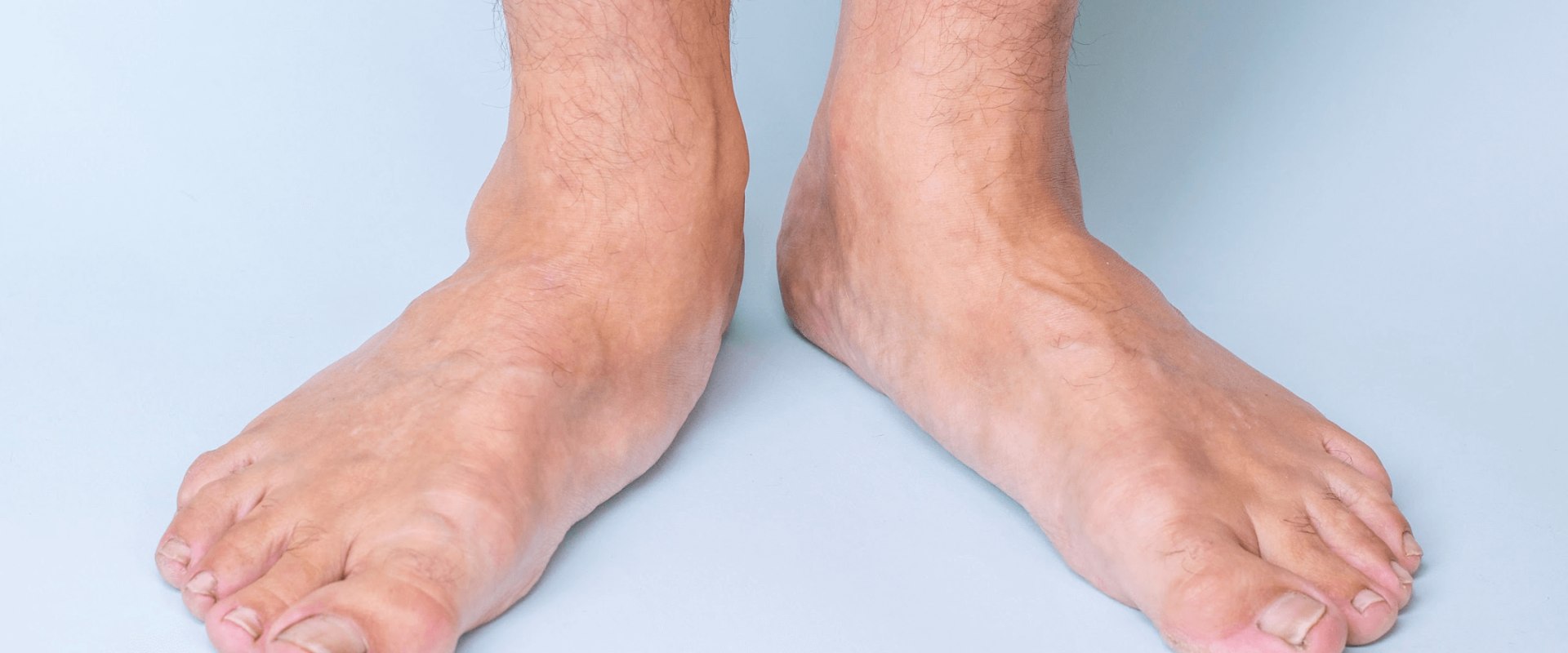 The Truth About Flat Feet: Causes, Treatment, and Prevention