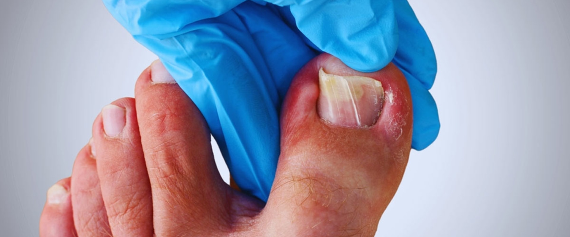 What Do Diabetic Toenails Look Like? Expert Advice for Those Dealing ...