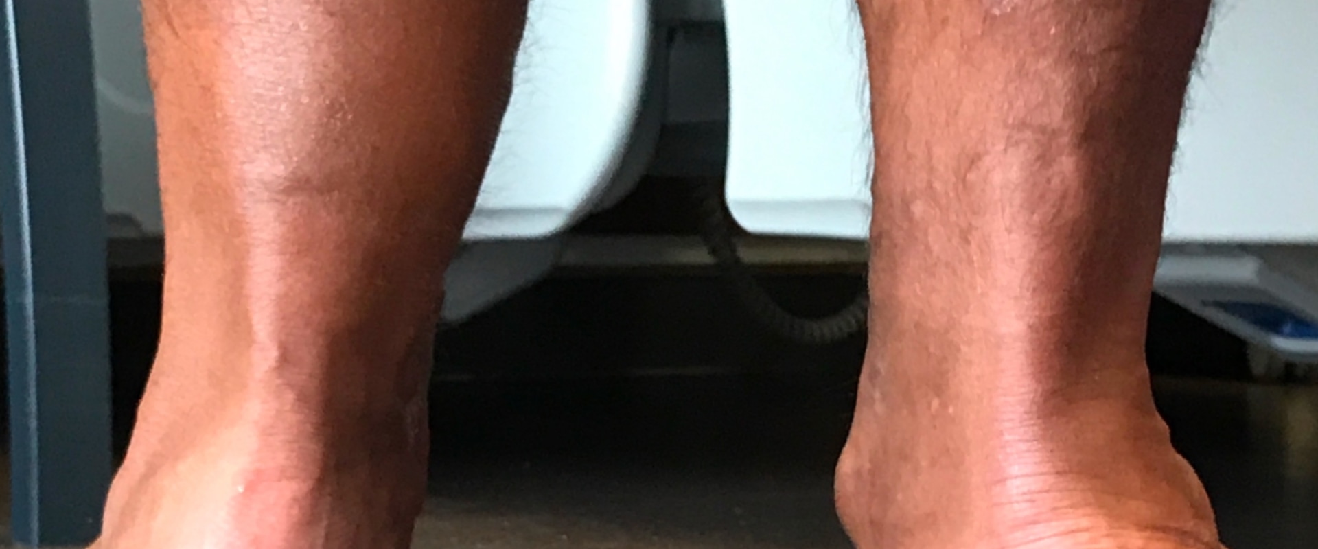 Fixing Flat Feet: What You Need to Know as an Expert